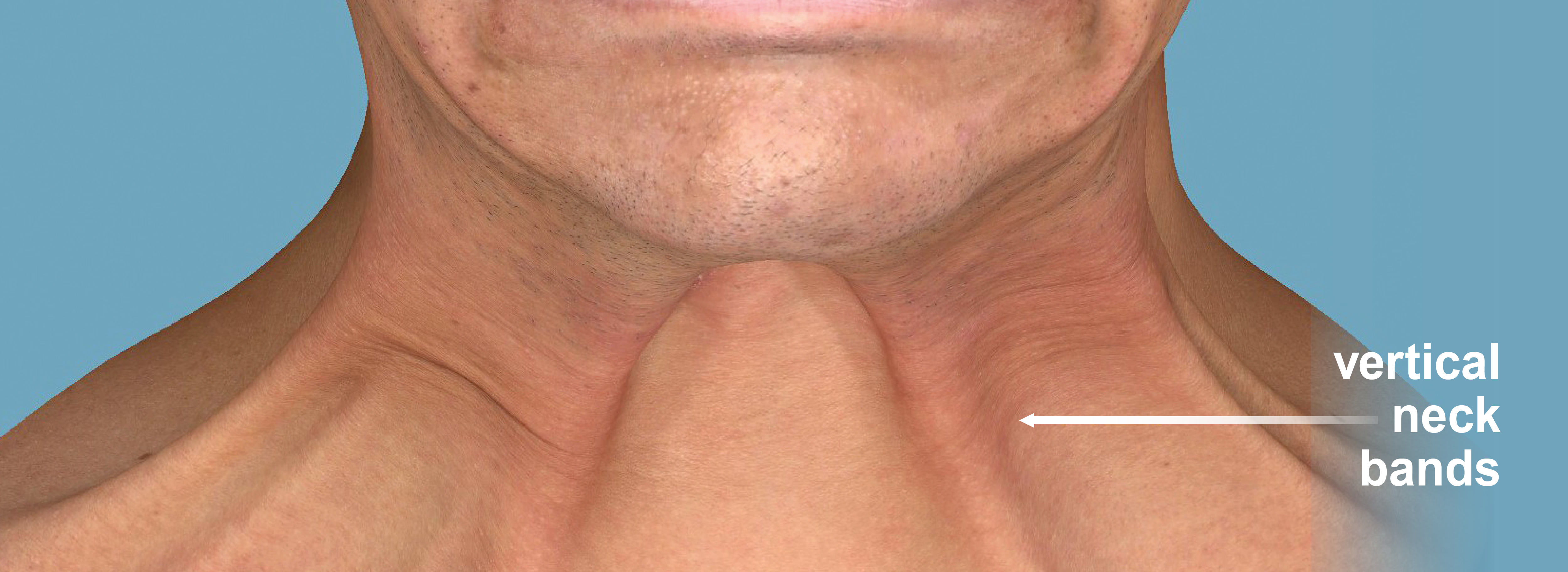 A Phase 2 Multicenter, Randomized, Double-Blind, Placebo-Controlled ...