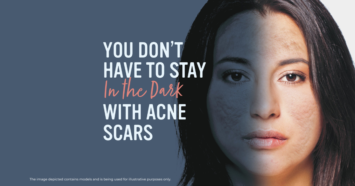 Acne Scar Study – Vince Bertucci, MD, FRCPC: Bertucci MedSpa