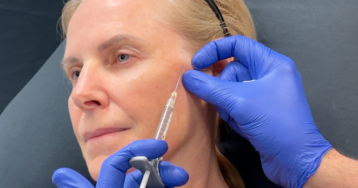 The Importance of Temple Filler – Vince Bertucci, MD, FRCPC: Bertucci ...